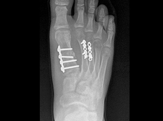 Metatarsianos (función, articulaciones, fracturas, importancia clínica)