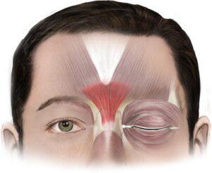 Músculo prócer (origen, inserción, acción, irrigación, inervación)