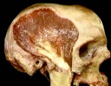 Músculo temporal (origen, irrigación, inervación y función)