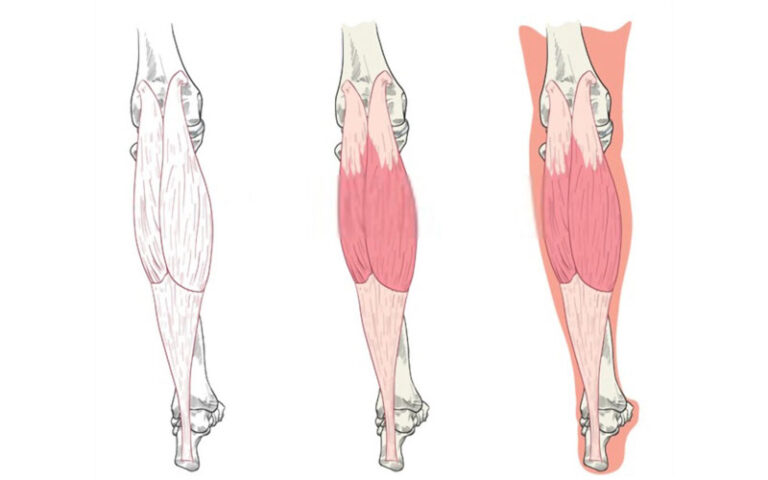 Músculo tríceps sural (anatómia, función, importancia clínica)