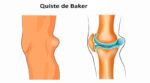 Fosa poplítea (anatomía, estructura e importancia clínica)