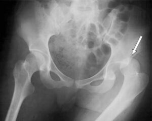 Articulación de la cadera (tipo, ligamentos, inervación)