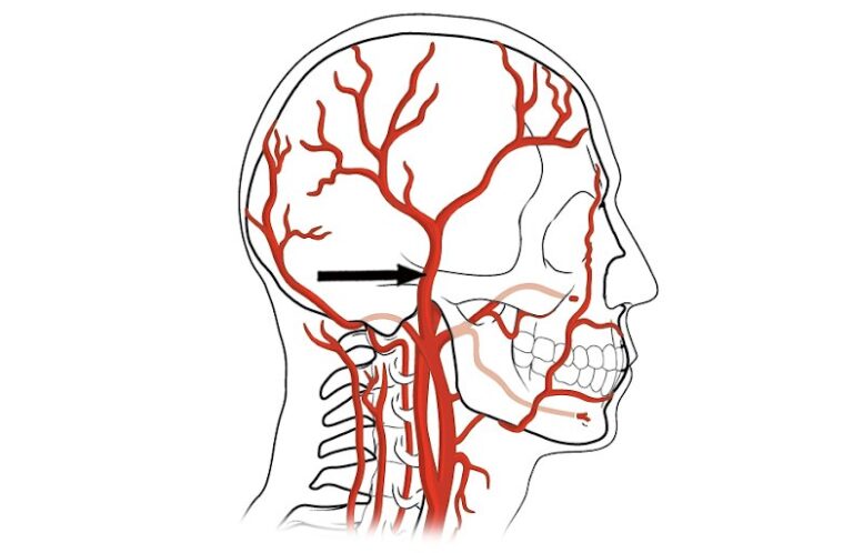Arteria temporal superficial (origen, ramas, irrigación)