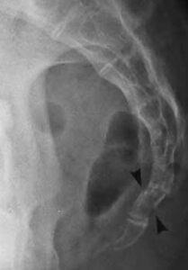 Hueso cóccix o coxis (anatomía, articulación, lesiones)